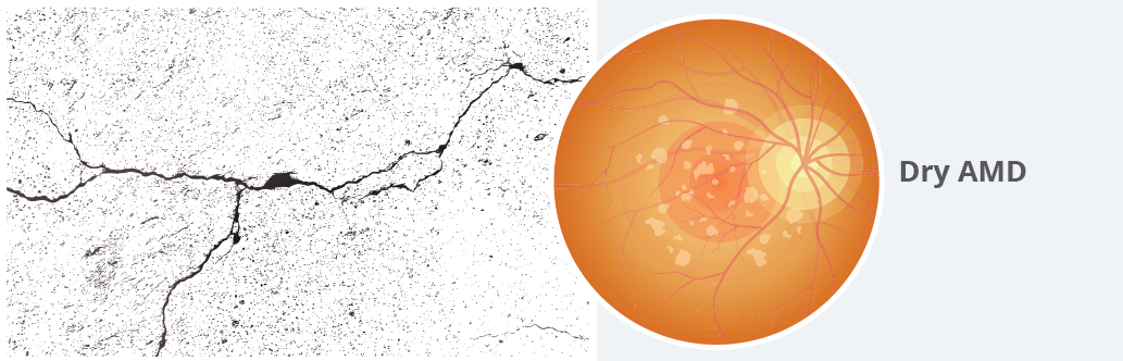 Age-related Macular Degeneration | See The Possibilities