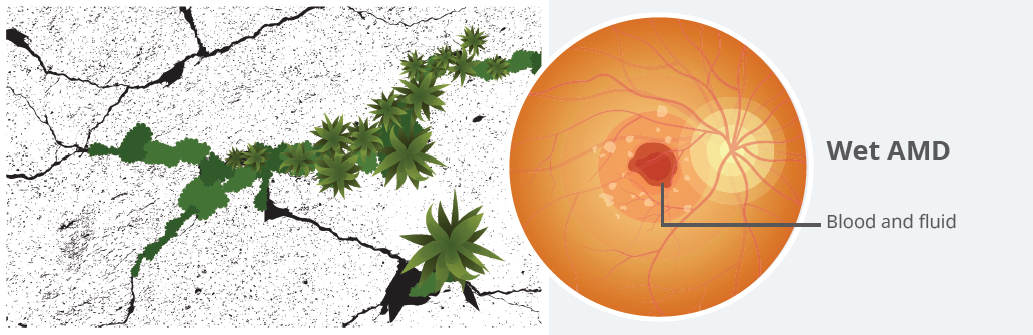 Age-related Macular Degeneration | See The Possibilities