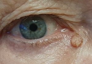 Periocular Skin Cancer and Oculoplastics | See The Possibilities